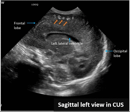 Subcortical bruising in the preterm infant | ADC Fetal & Neonatal Edition