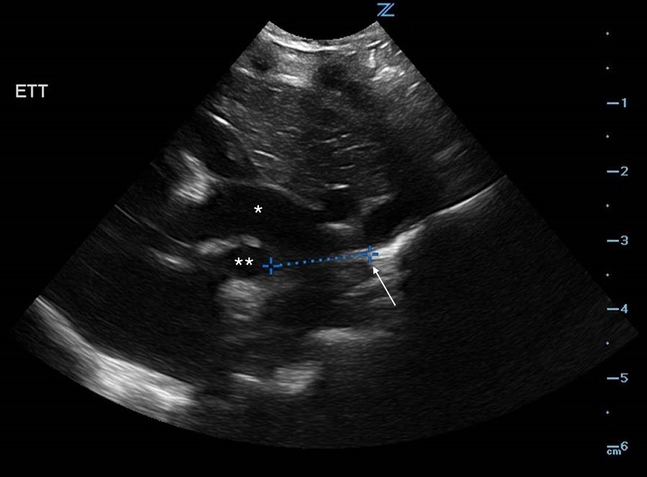 Ultrasound assessment of endotracheal tube depth in neonates: a ...